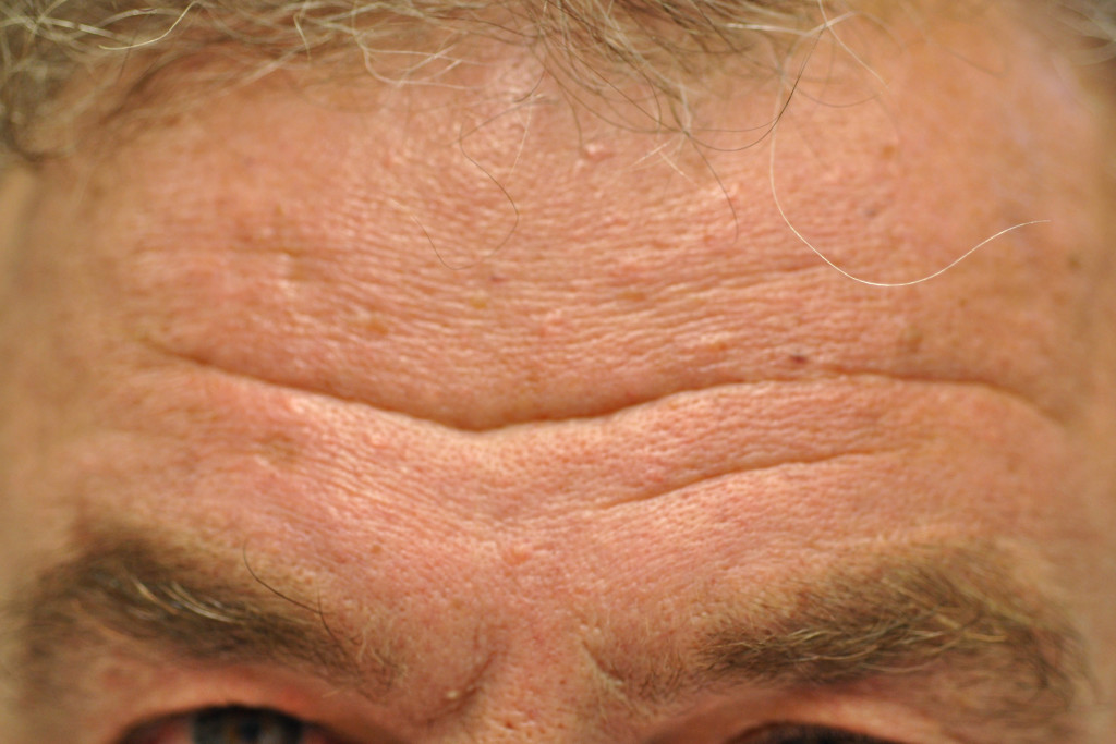 Botox - GK Dermatology, PC
