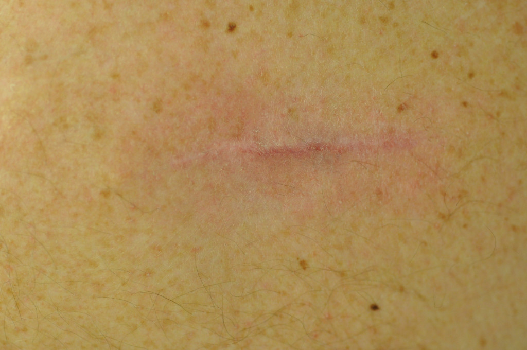 Excision - GK Dermatology, PC