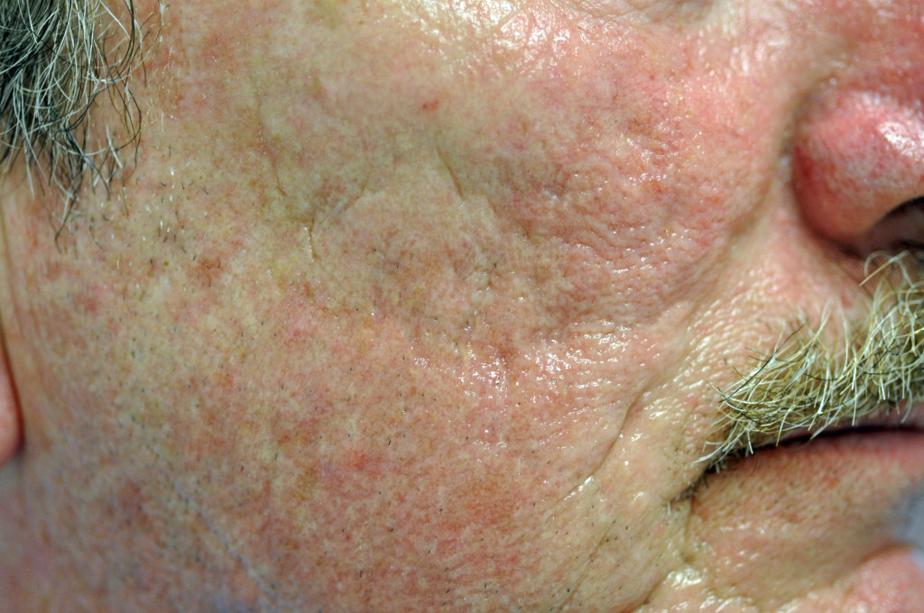 Subcision Before & After Photos- GK Dermatology, PC