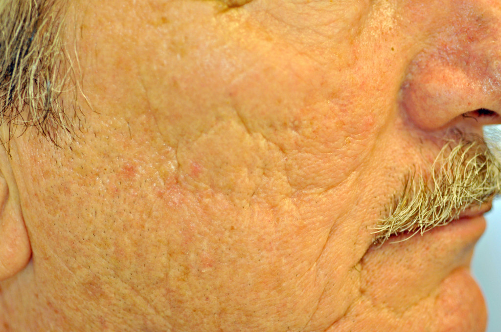 Subcision Before & After Photos- GK Dermatology, PC