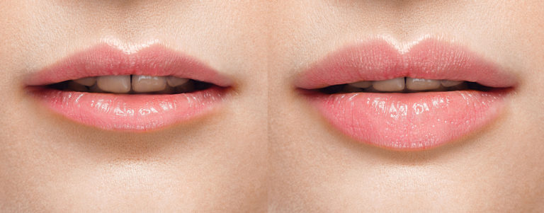 South Shore MA Lip Rejuvenation Options | GK Dermatology