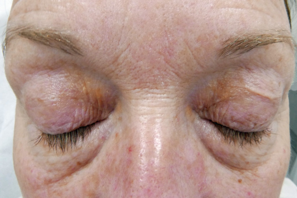 Fibroblast Plasma Pen - GK Dermatology, PC | Boston MA