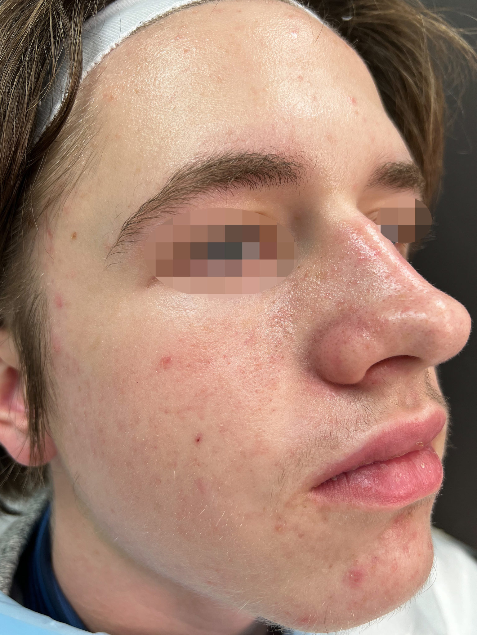 Radiofrequency Microneedling - GK Dermatology, PC