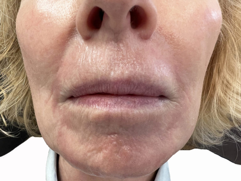 Chemical Peels (Deep) - GK Dermatology, PC