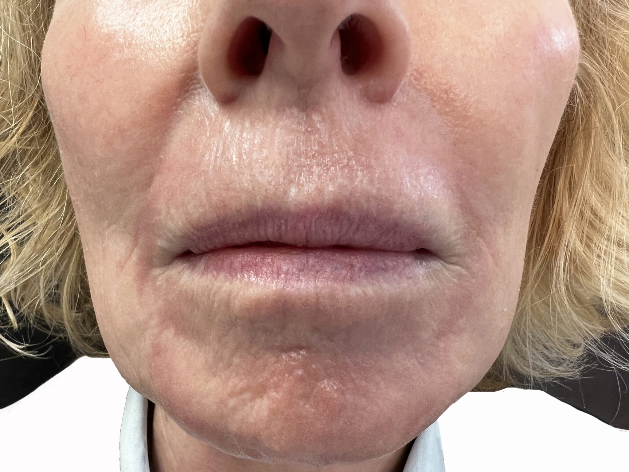 Chemical Peels (Deep) - GK Dermatology, PC