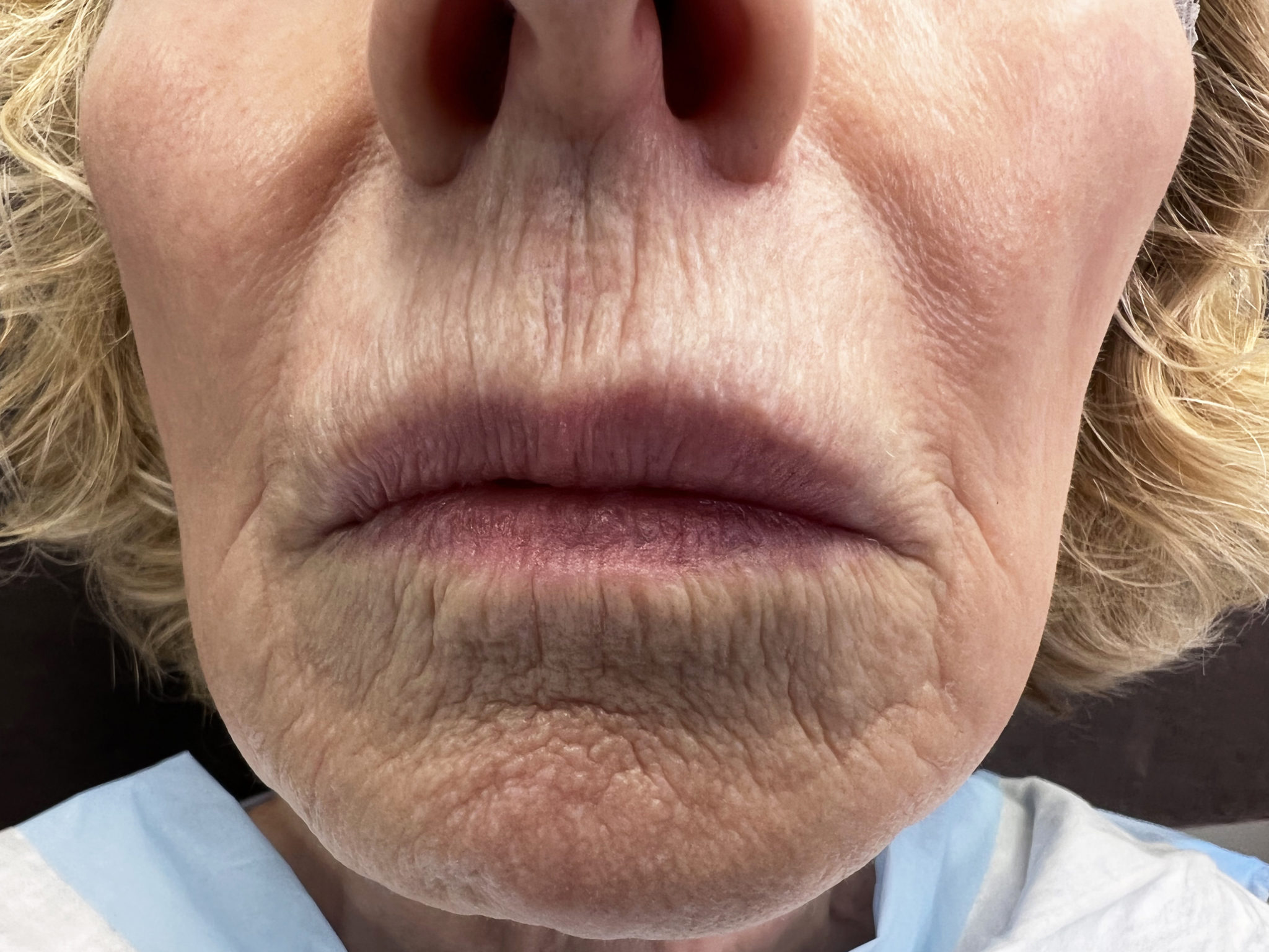 Chemical Peels (Deep) - GK Dermatology, PC