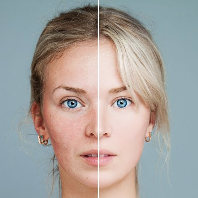 Deep Skin Resurfacing With Phenol-Croton Oil Peel - GK Dermatology, PC